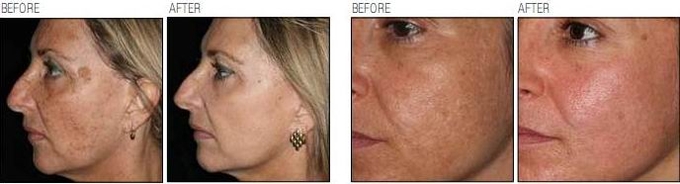 pigmentation removal scar removal