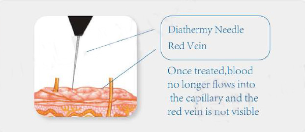 Advanced best treatment for varicose veins laser treatment cost