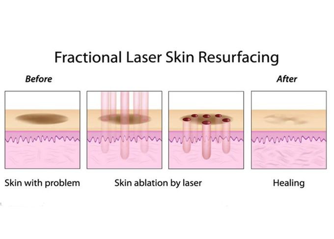 Skin Resurfacing 10600nm Fractional Laser Machine Co2 1