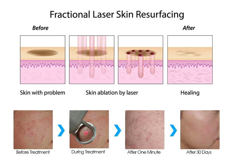 LaserTell Dermatology Equipment Erbium Laser Resurfacing Fractional CO2 Laser SPA commercial use 4